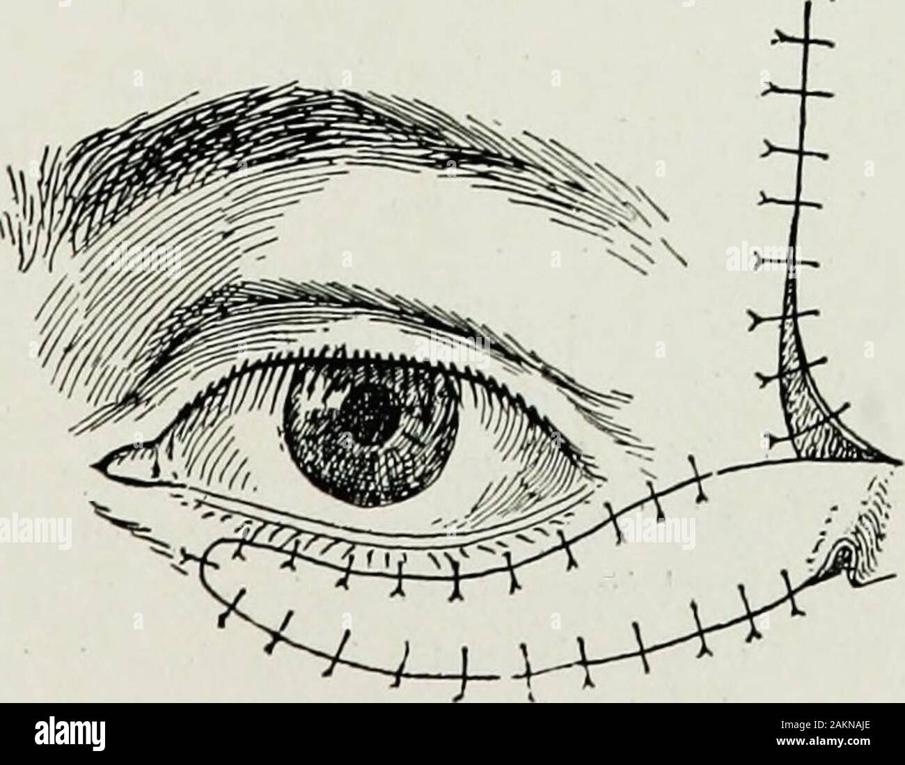 Flap excision hi-res stock photography and images - Alamy