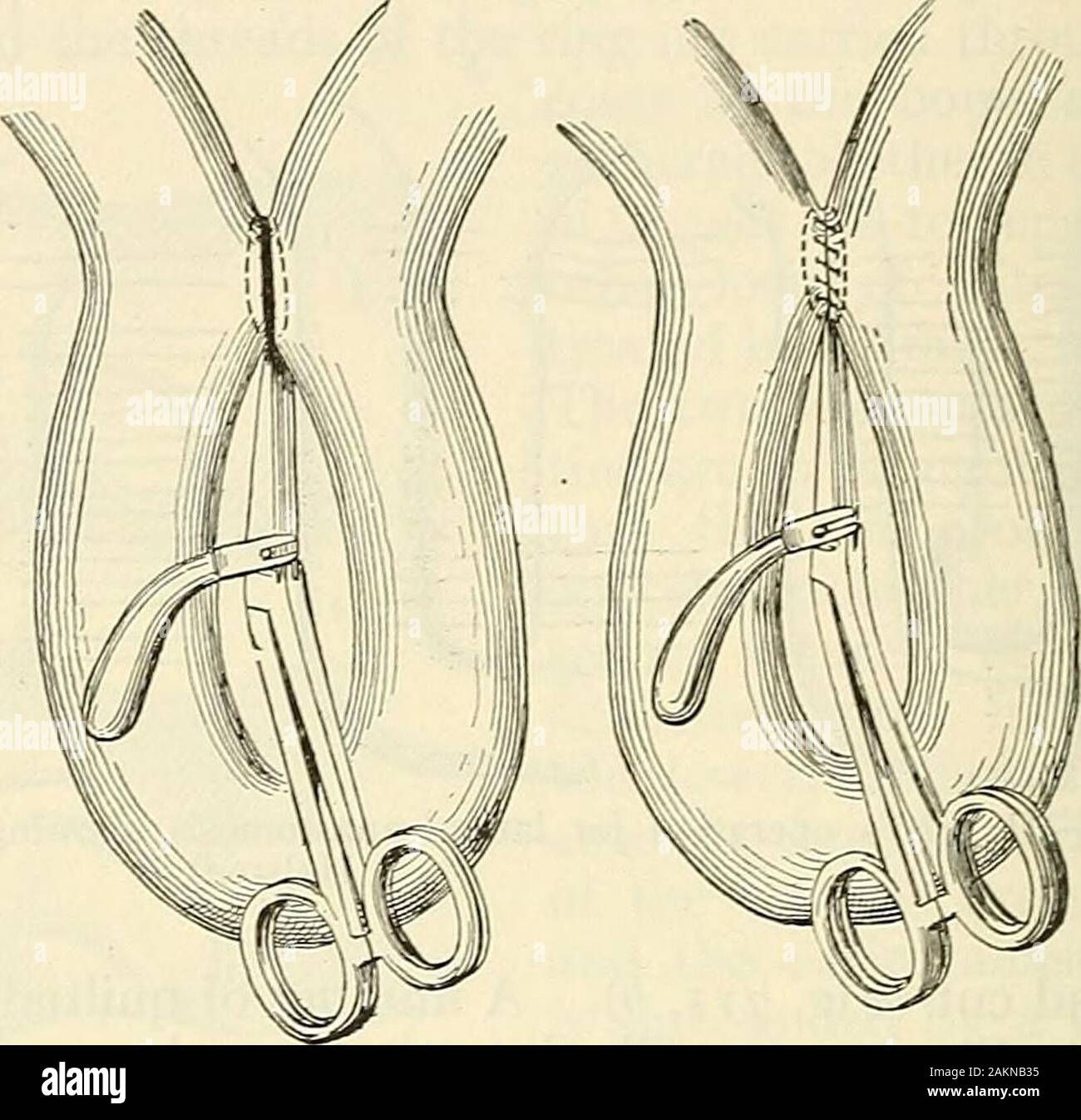 Modern surgery, general and operative . Fig. 714.—Lateral anastomosis ...