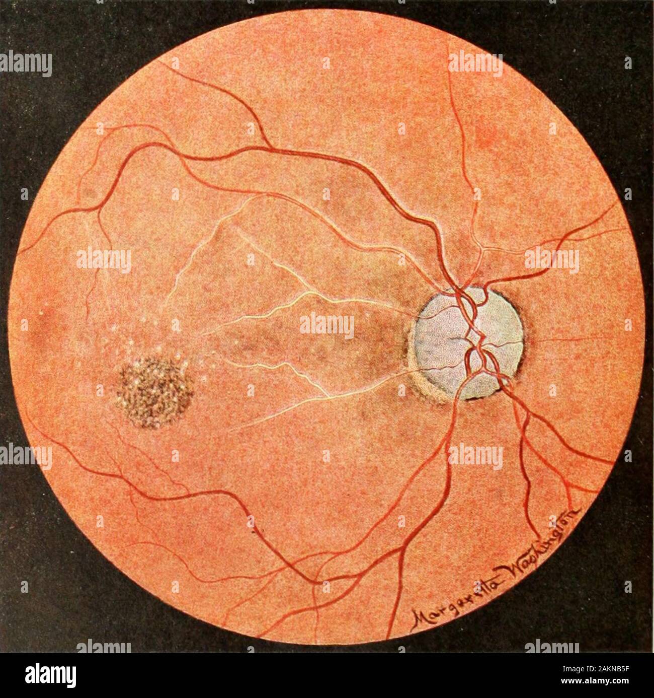 Transactions . Fig. 2. Extensive perivasculitis following obstruction ...