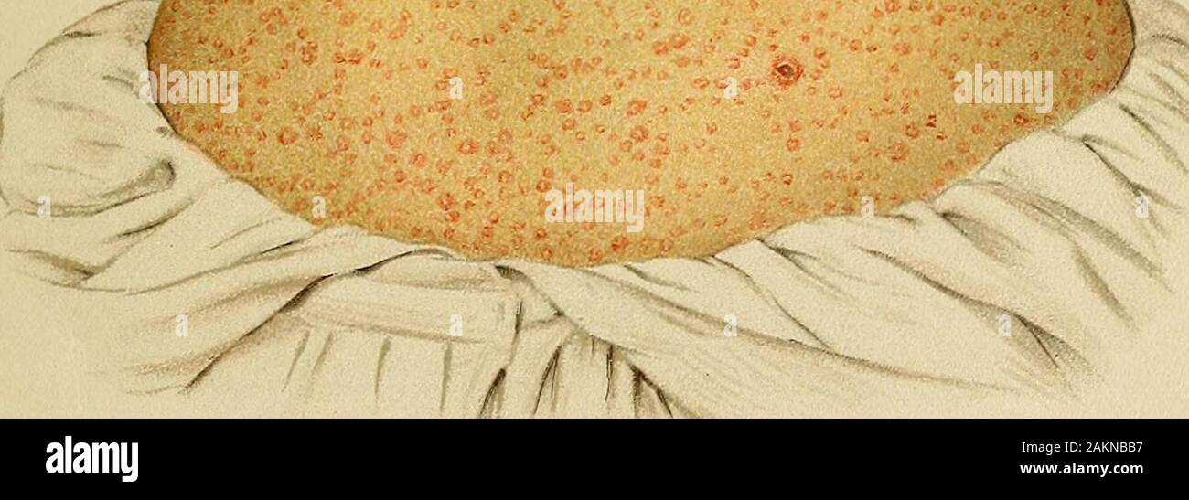 Ulcerating hi-res stock photography and images - Alamy