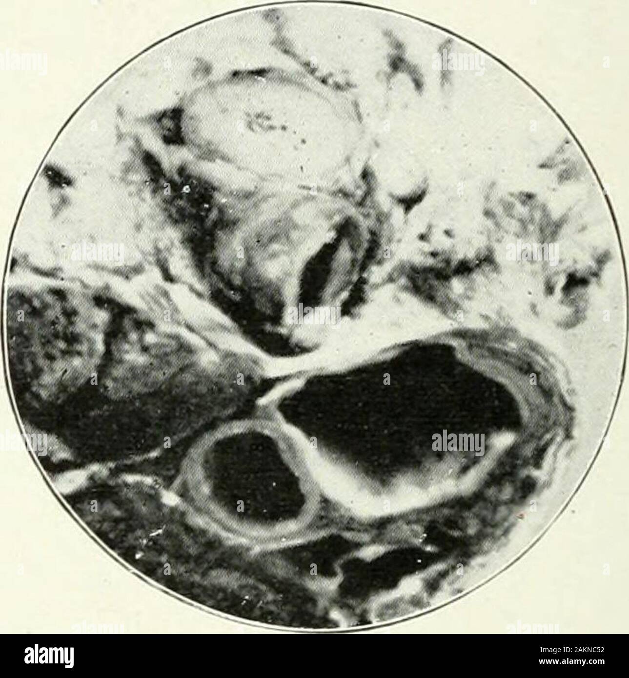 Edema macular hi-res stock photography and images - Alamy