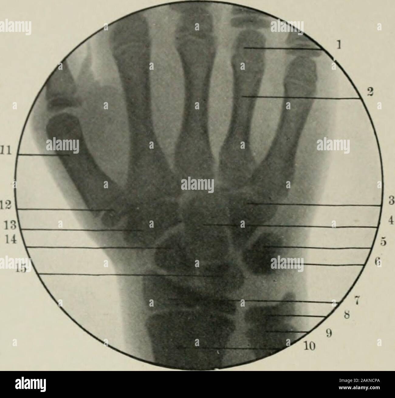 Ulna proximal hi-res stock photography and images - Alamy
