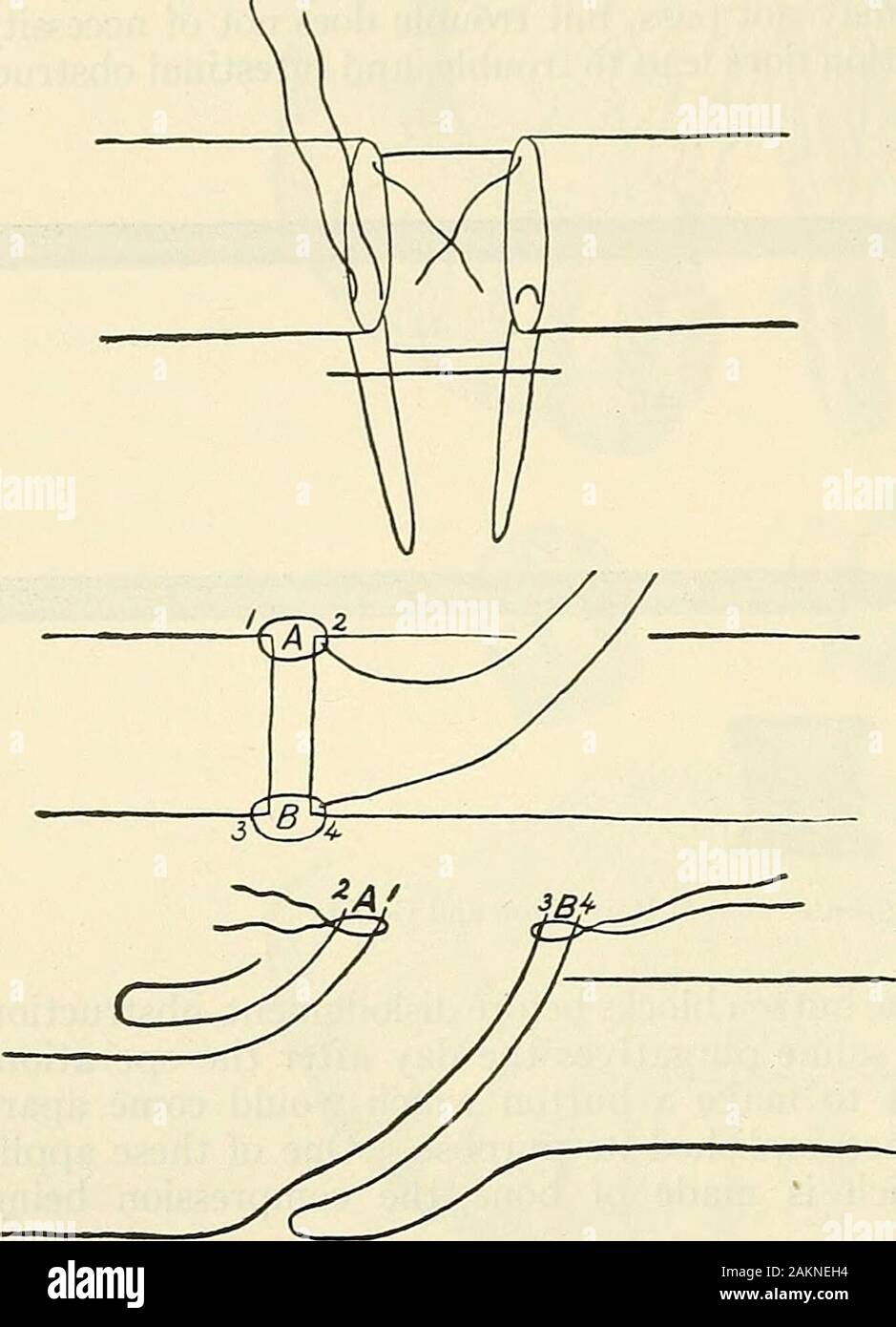 Modern surgery, general and operative . , 1904).During the suturing ...