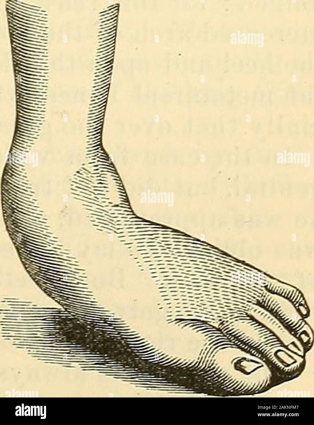 Talipes valgus hi-res stock photography and images - Alamy