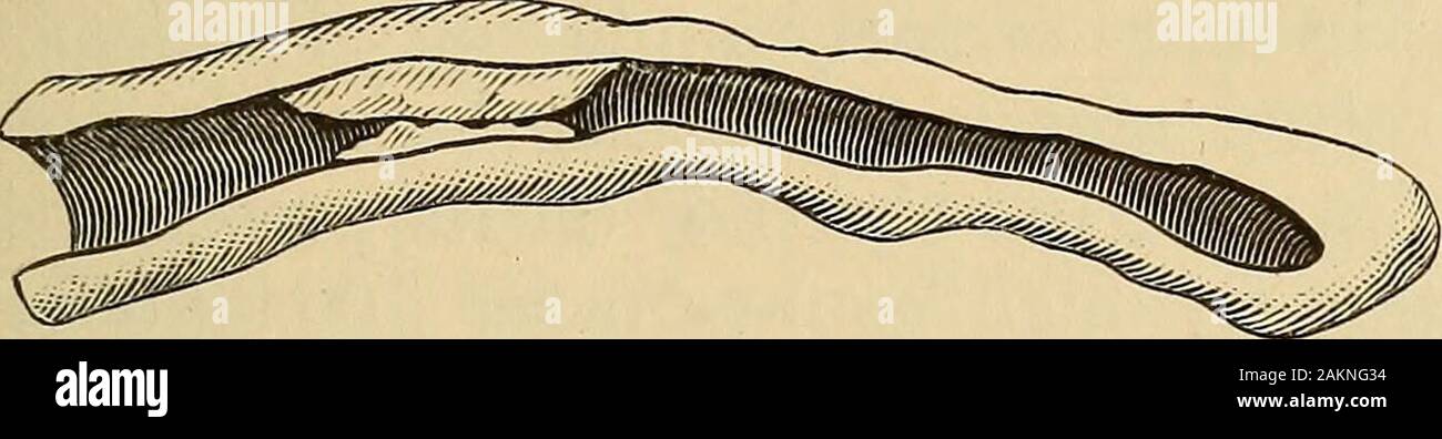 Bowel perforation hi-res stock photography and images - Alamy