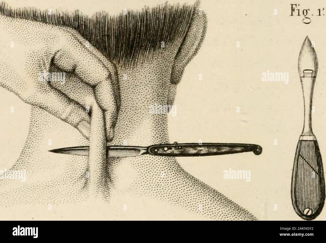 Fil de suture hi-res stock photography and images - Alamy