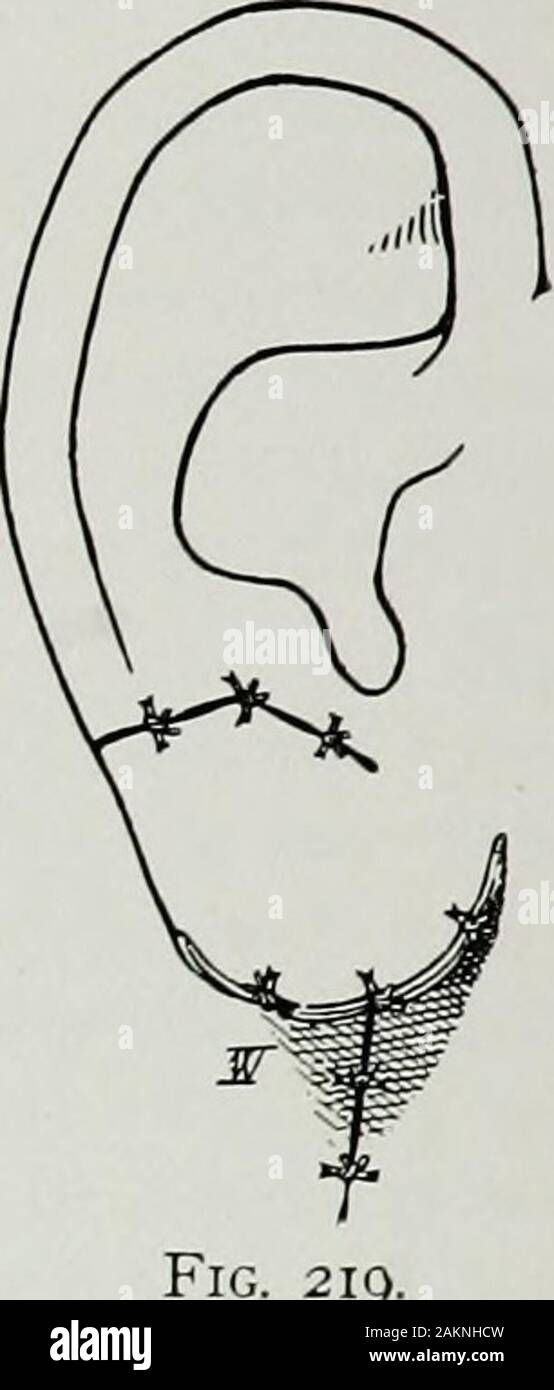 Avulsion Wound Definition