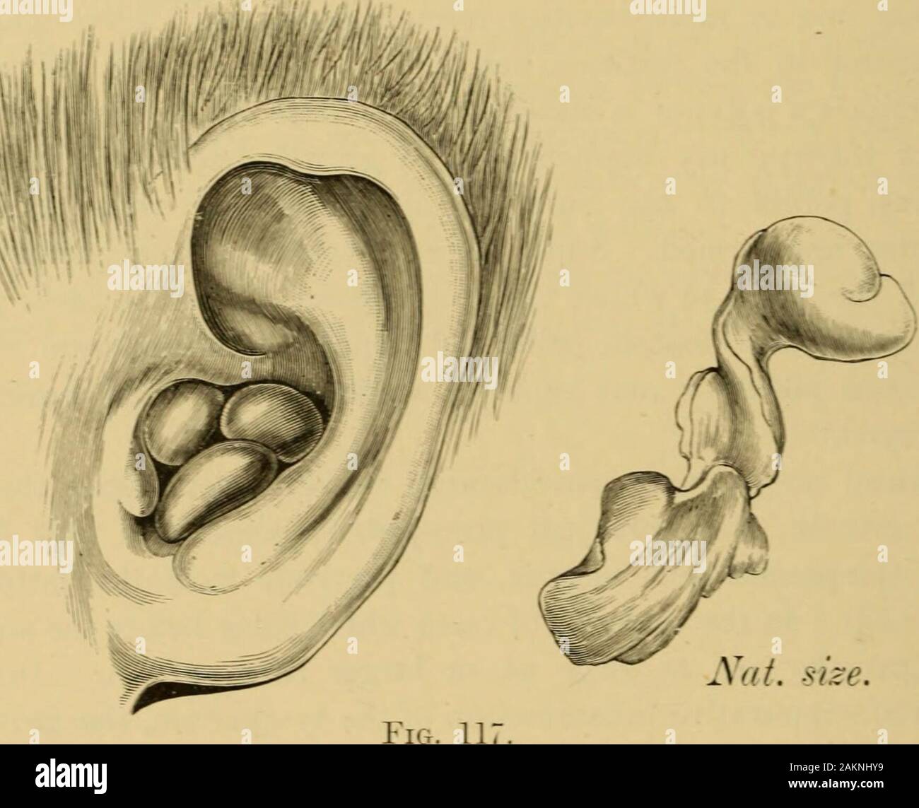 Discharge ear hi-res stock photography and images - Alamy