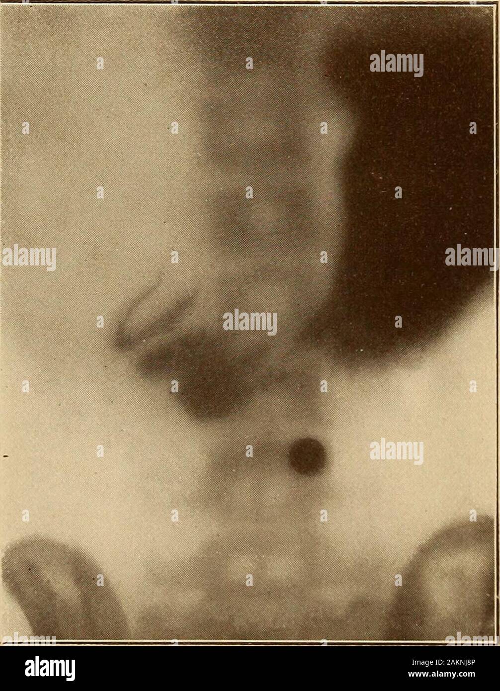 A treatise on the principles and practice of medicine . Fig. S.—Ulcer ...