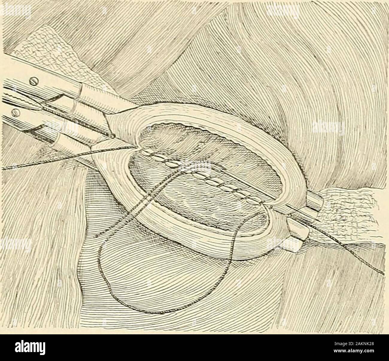 Mesocolon hi-res stock photography and images - Alamy