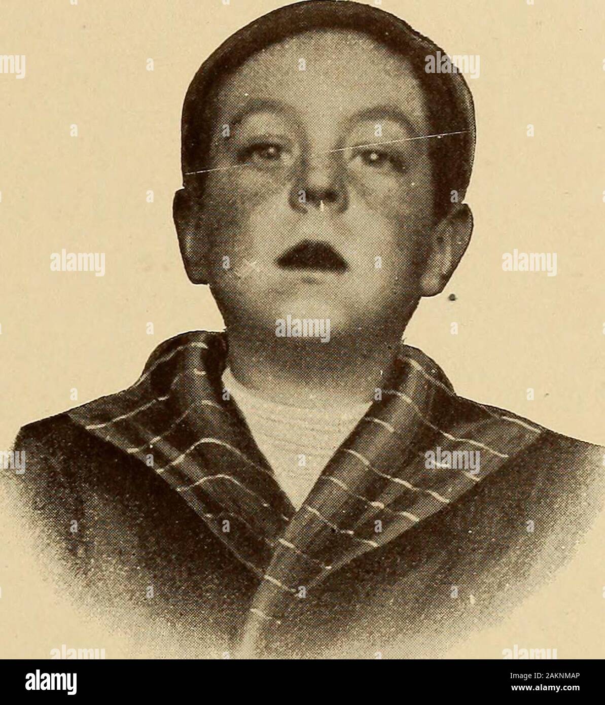 Rhinolalia hi-res stock photography and images - Alamy