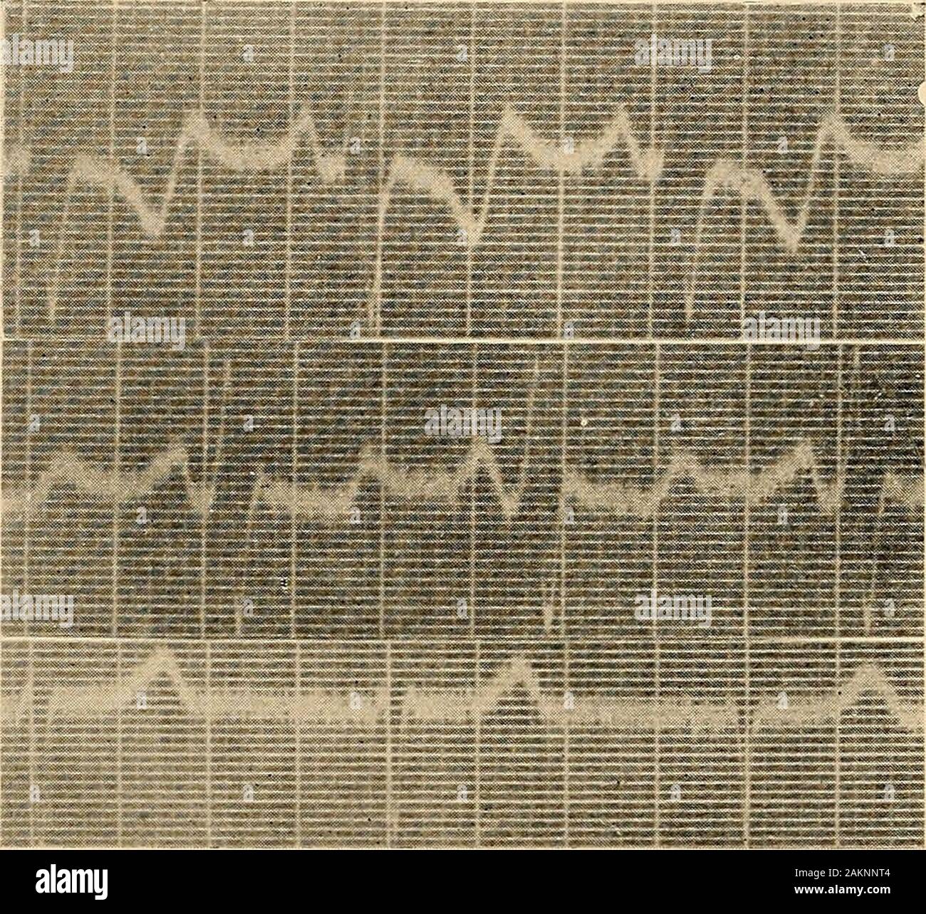 Clinical electrocardiography . Fig. 162.—Patient had had angina ...
