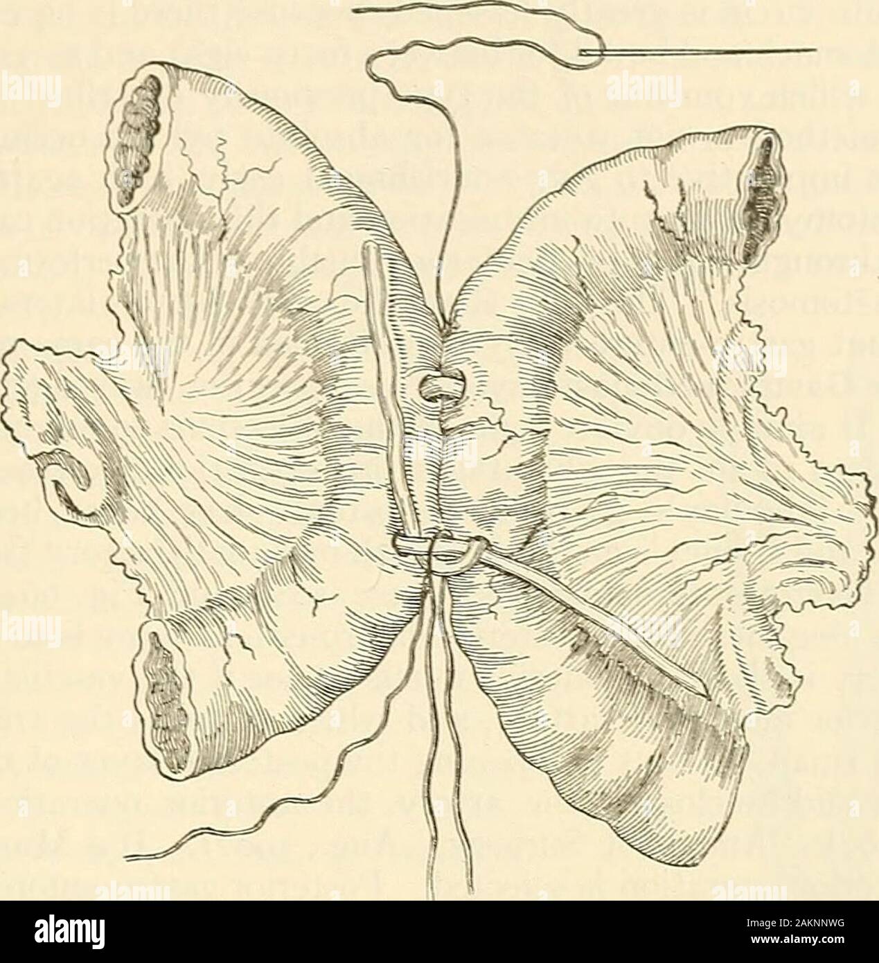 Kocher incision hi-res stock photography and images - Alamy