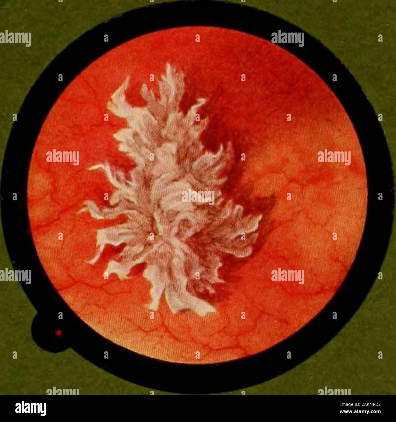 Traitâe pratique de cystoscopie et de cathâetâerisme urâetâeral . Fig ...