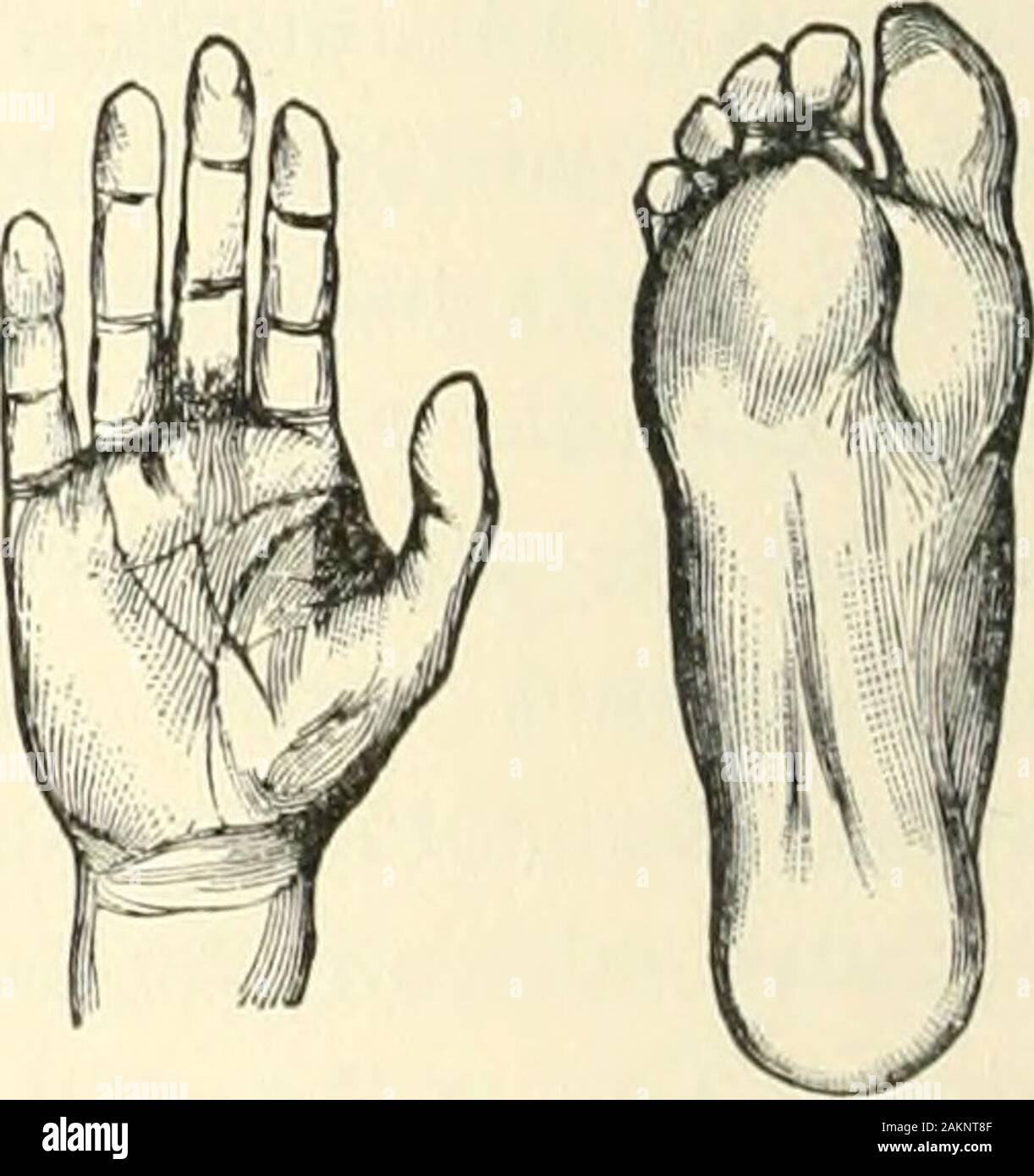 Pinch foot hi-res stock photography and images - Alamy