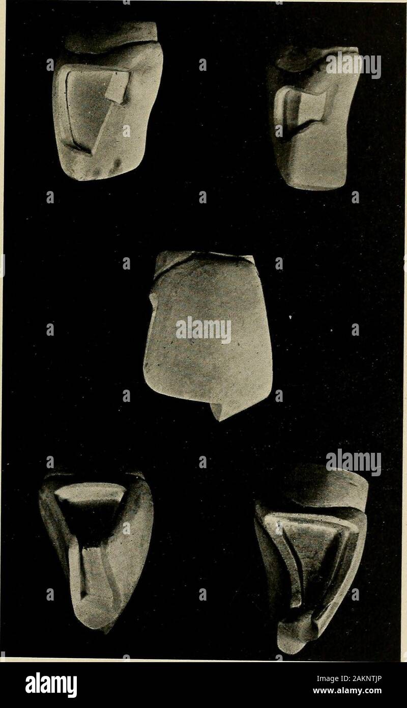 Principles and practice of operative dentistry . II. Simple Approximal ...