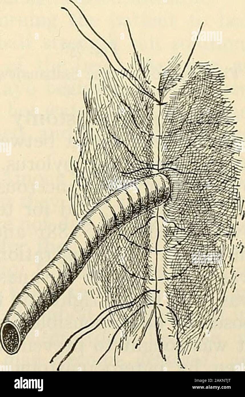 Parietal peritoneum hi-res stock photography and images - Alamy