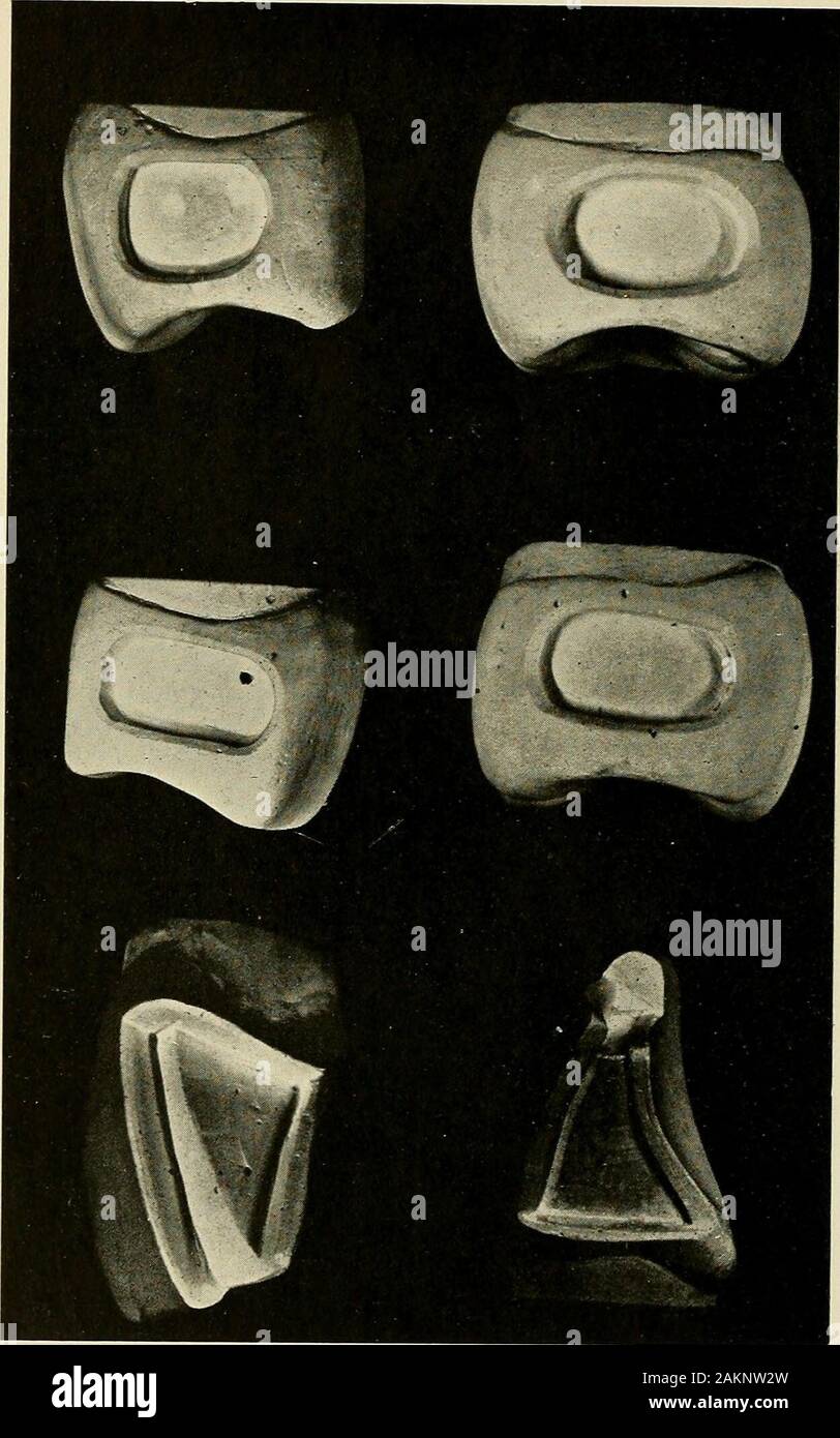 Principles and practice of operative dentistry . I. Simple Cavities ...