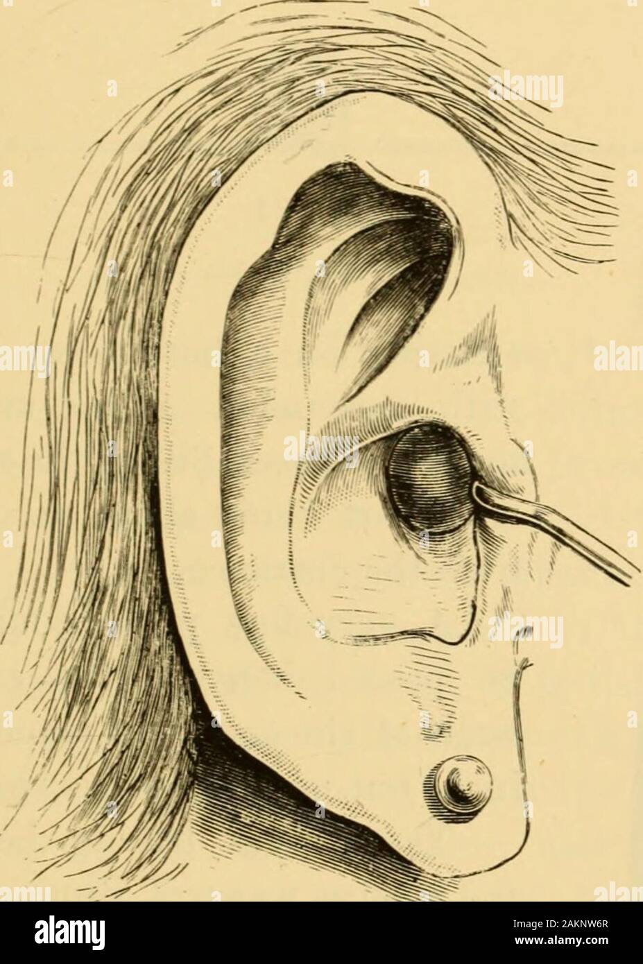 A treatise on the diseases of the ear including the anatomy and ...