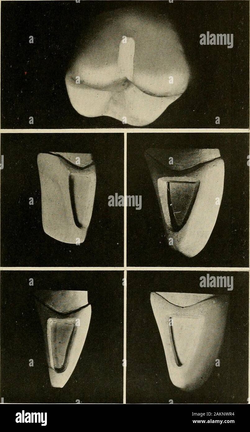 Principles and practice of operative dentistry . I. Simple Cavities ...