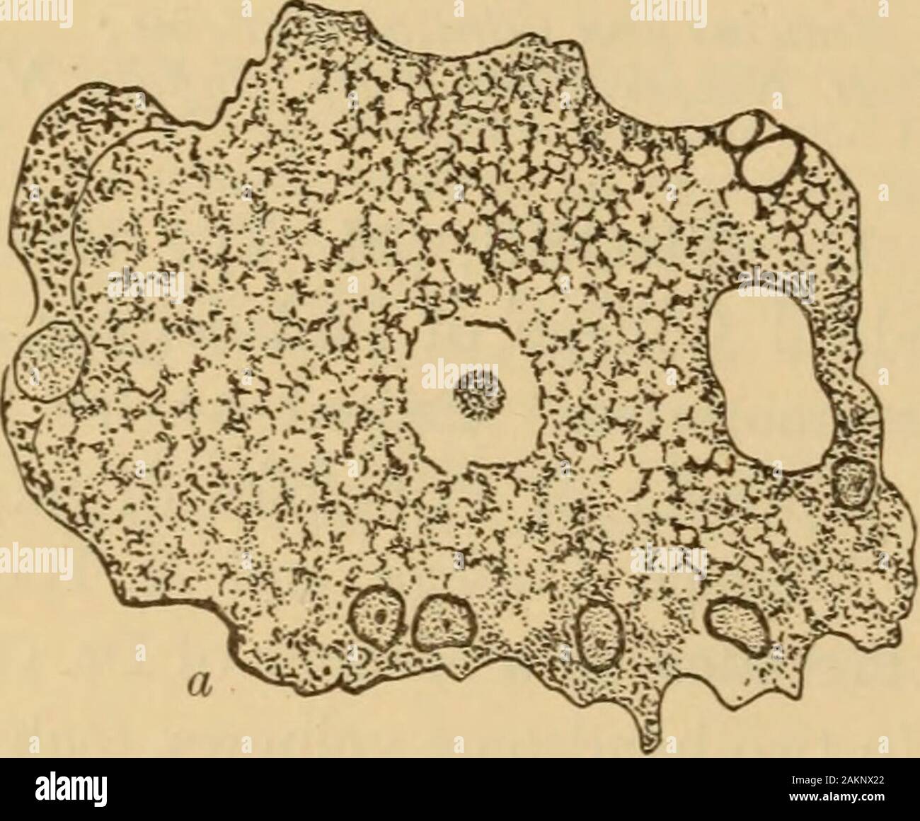 An American text-book of the diseases of children .. . Infiltration of ...