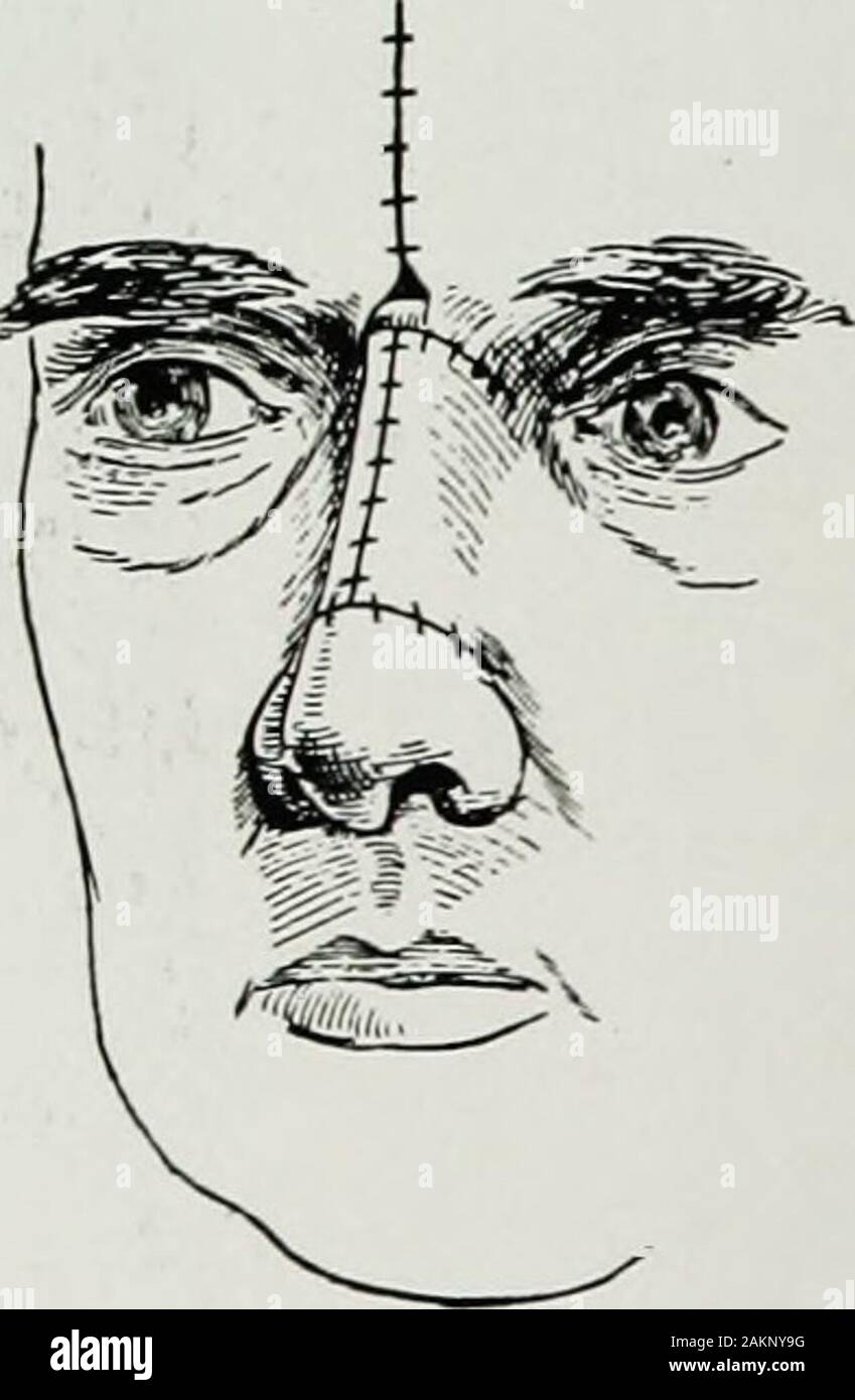 Nose Webbing Birth Defect