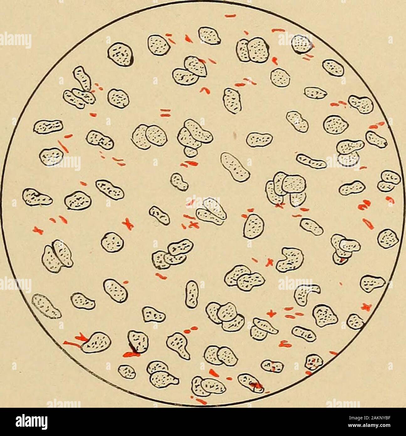 Osseous tuberculosis hi-res stock photography and images - Alamy