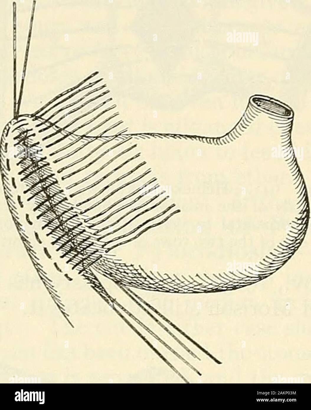 Modern surgery, general and operative . Fig. 643.- -Finneys ...