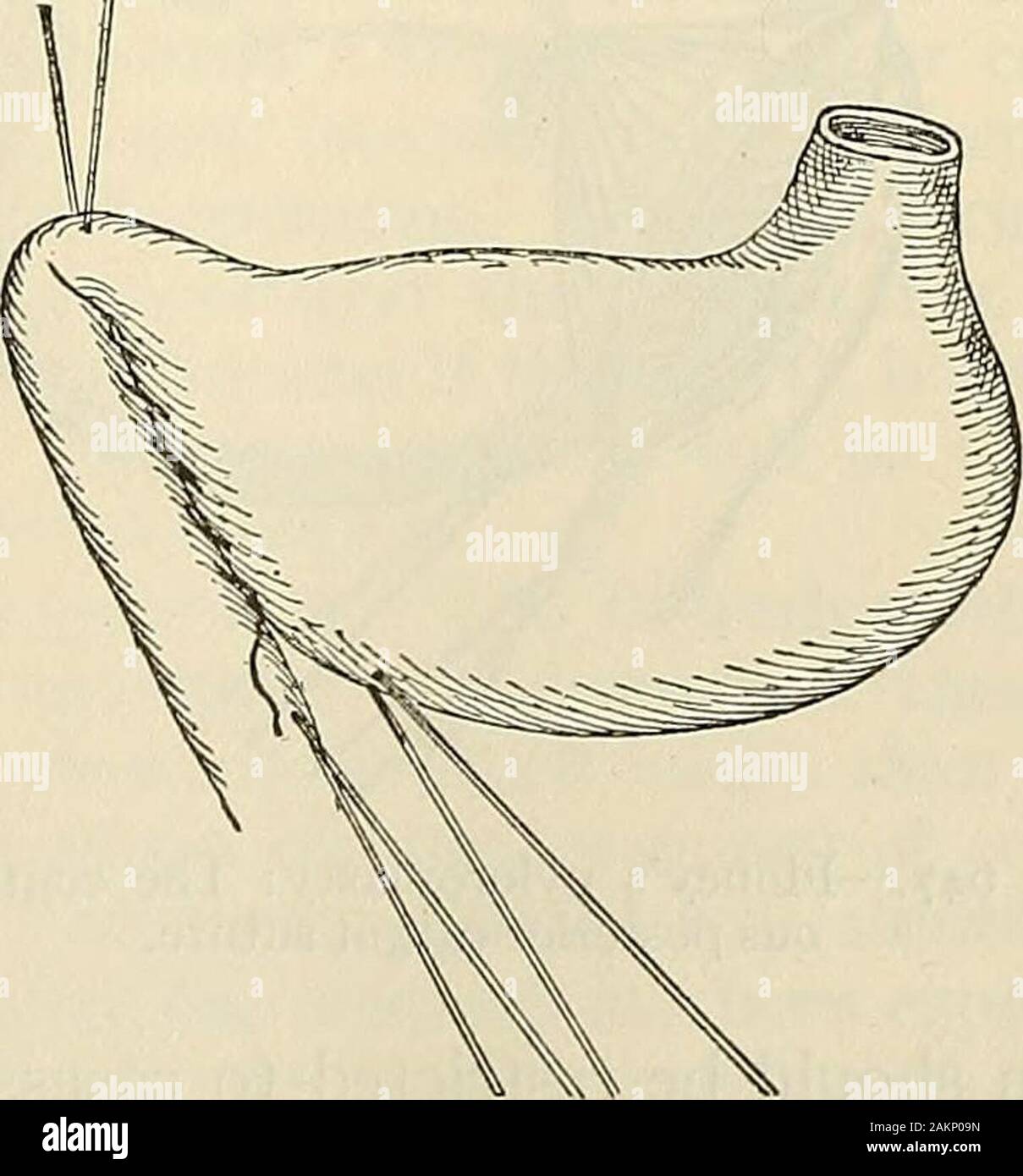 Modern surgery, general and operative . Fig. 643.- -Finneys ...