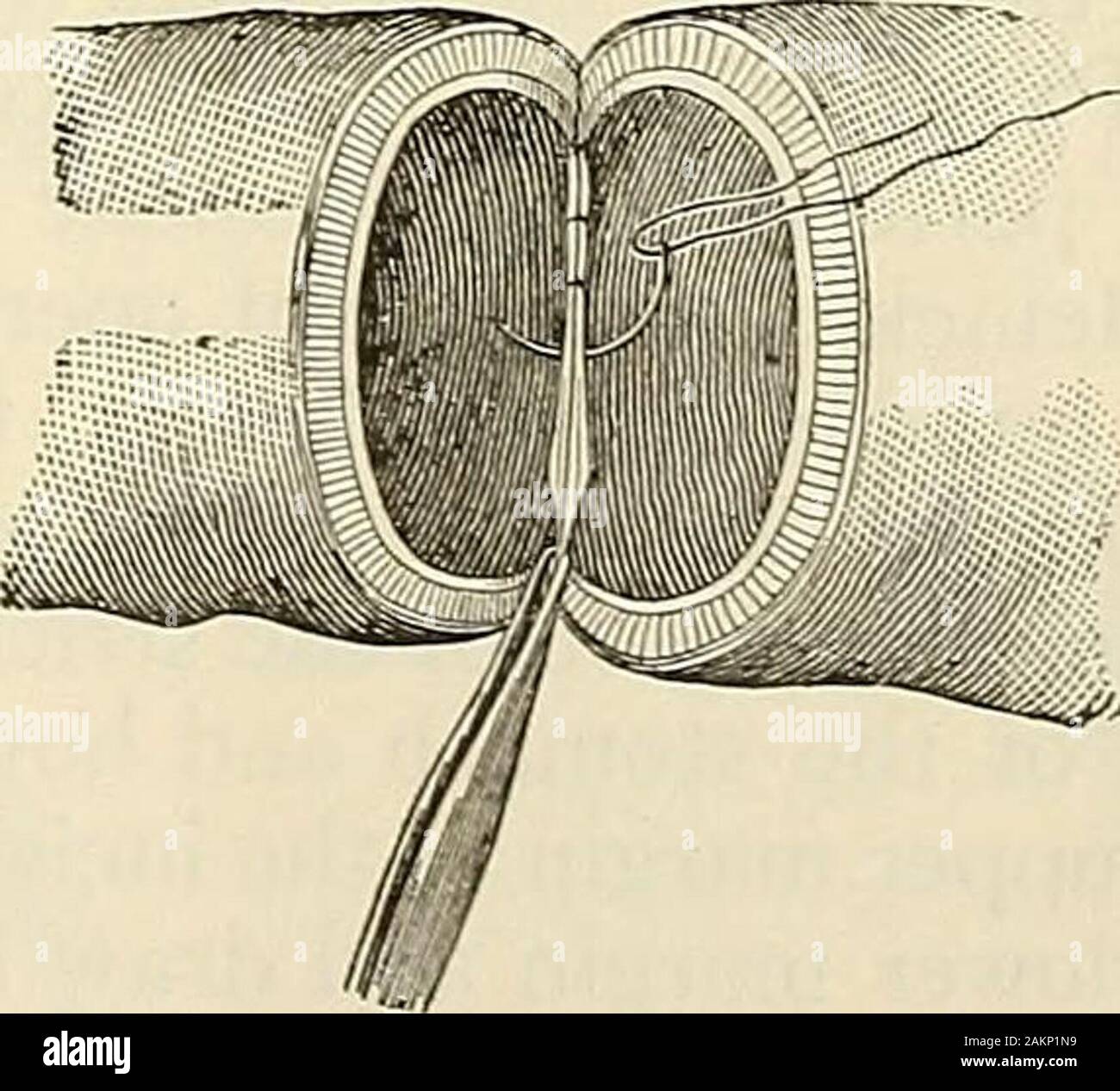 Sutures stomach hi-res stock photography and images - Alamy