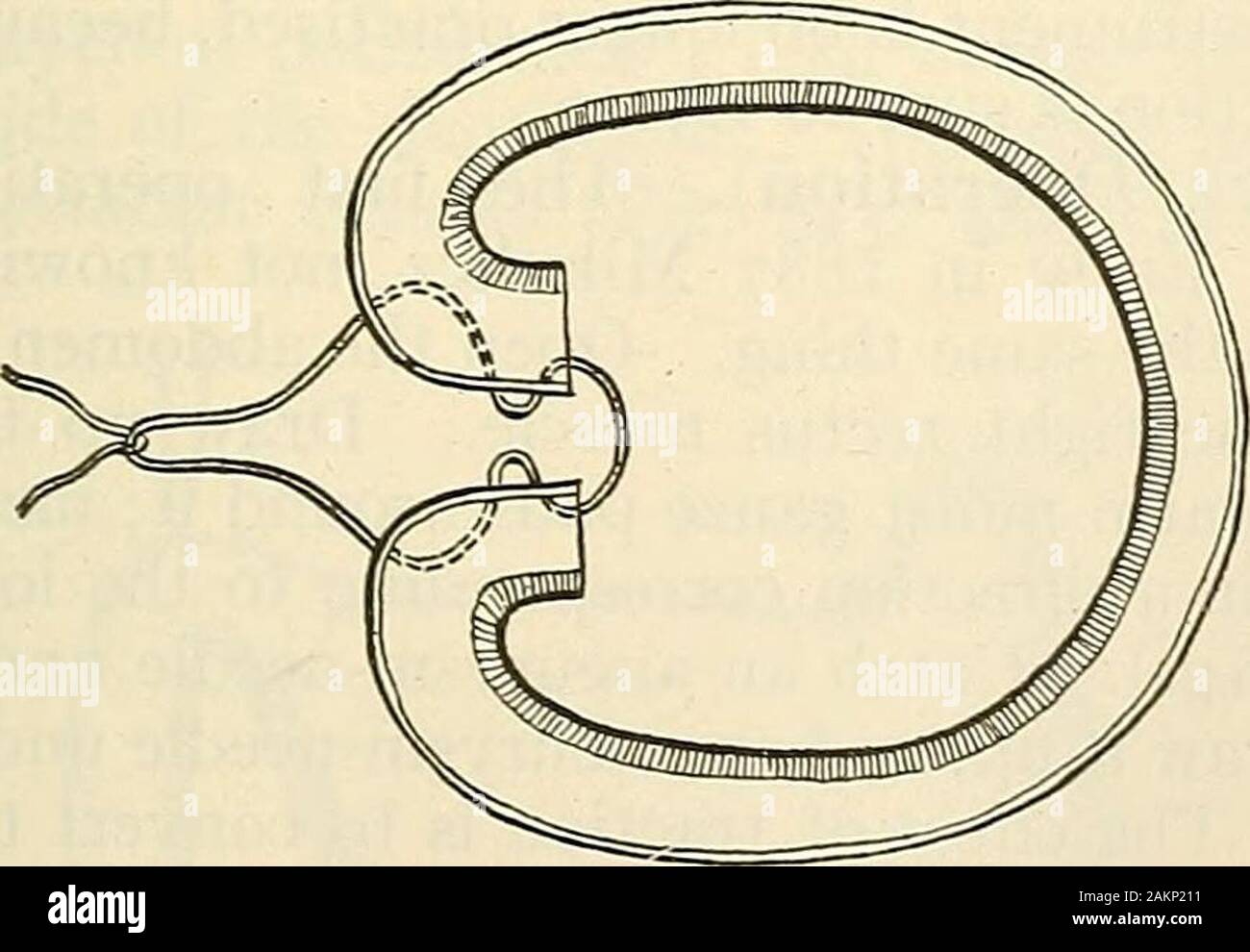 Modern surgery, general and operative . Fig. 636.—Czemy-Lembert suture ...