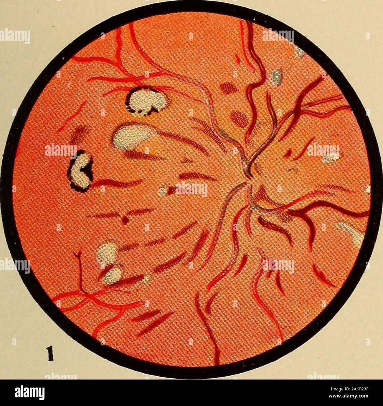 A treatise on the principles and practice of medicine . is caused by ...