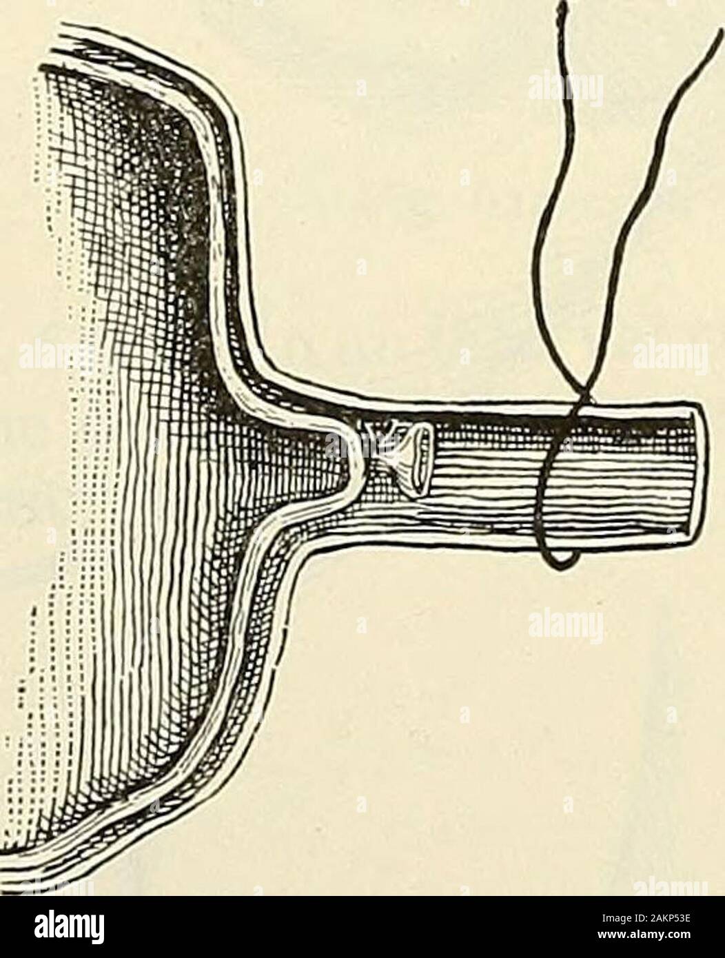 Modern surgery, general and operative . ollows:Pass a ligature through ...