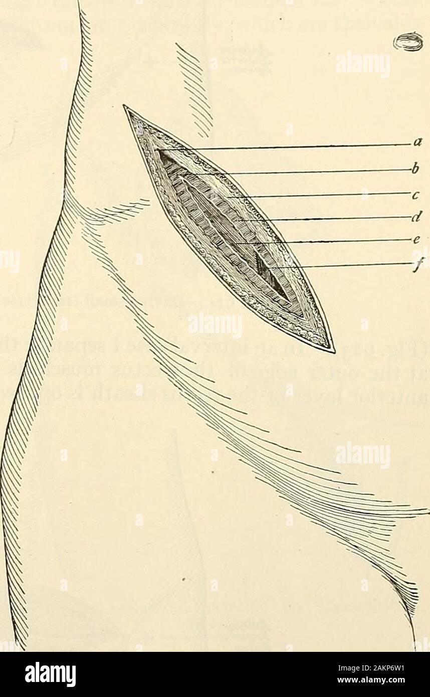 Appendix Abscess High Resolution Stock Photography and Images - Alamy