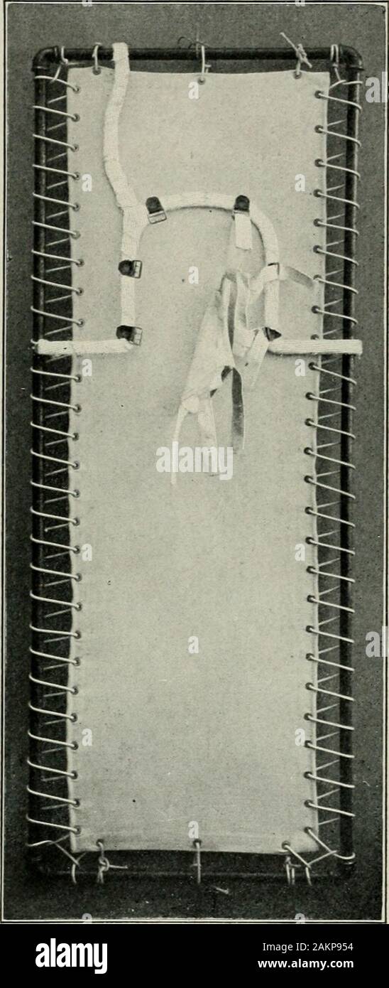 The thomas splint hi-res stock photography and images - Alamy