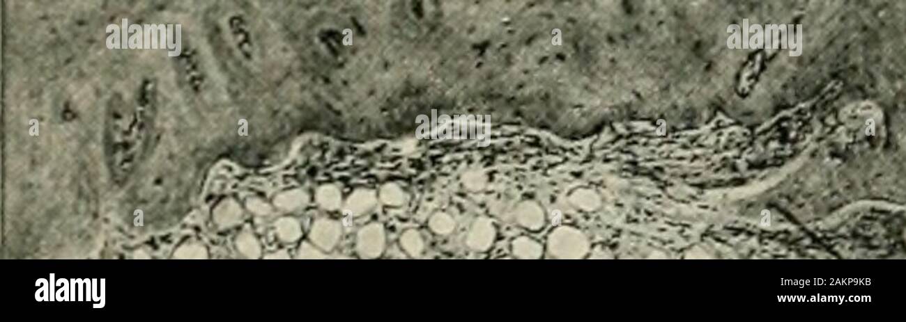 Granulation tissues hi-res stock photography and images - Alamy