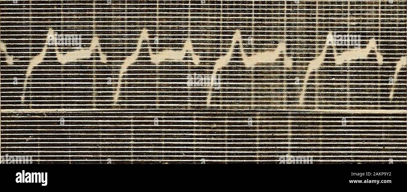 Clinical electrocardiography . Fig. 133.—Electrocardiogram of patient ...
