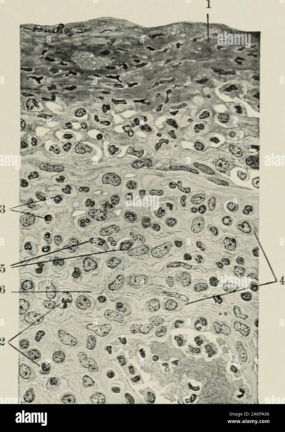 Phlegmonous hi-res stock photography and images - Alamy