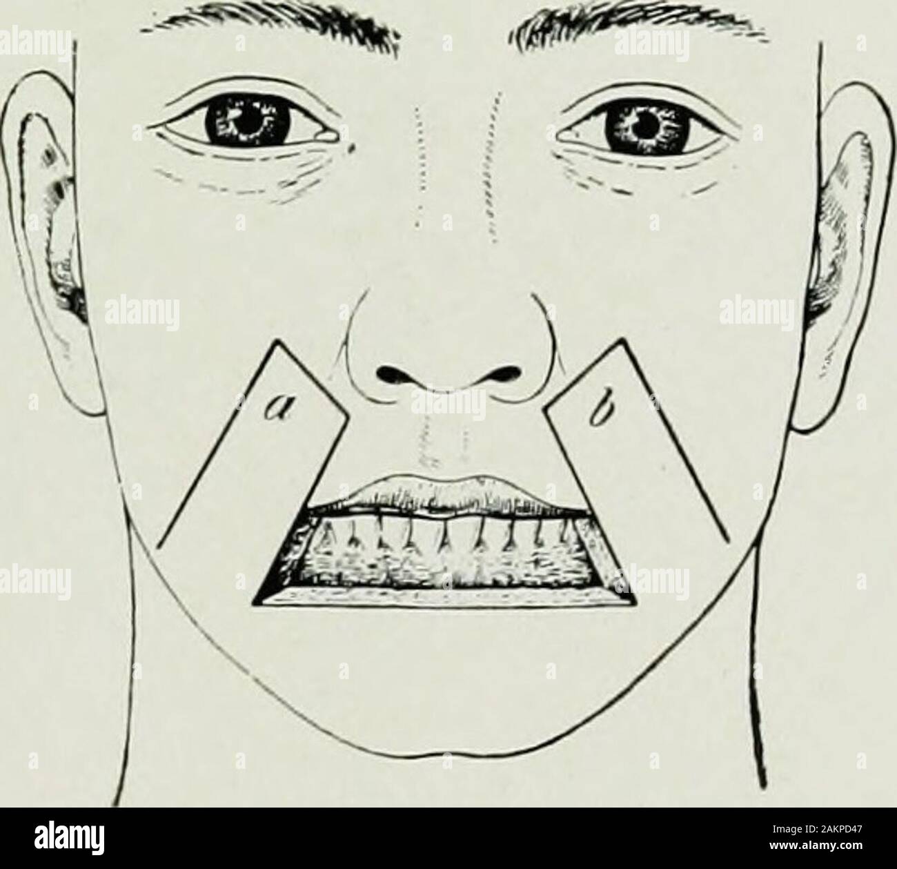 Scar on lip hi-res stock photography and images - Alamy