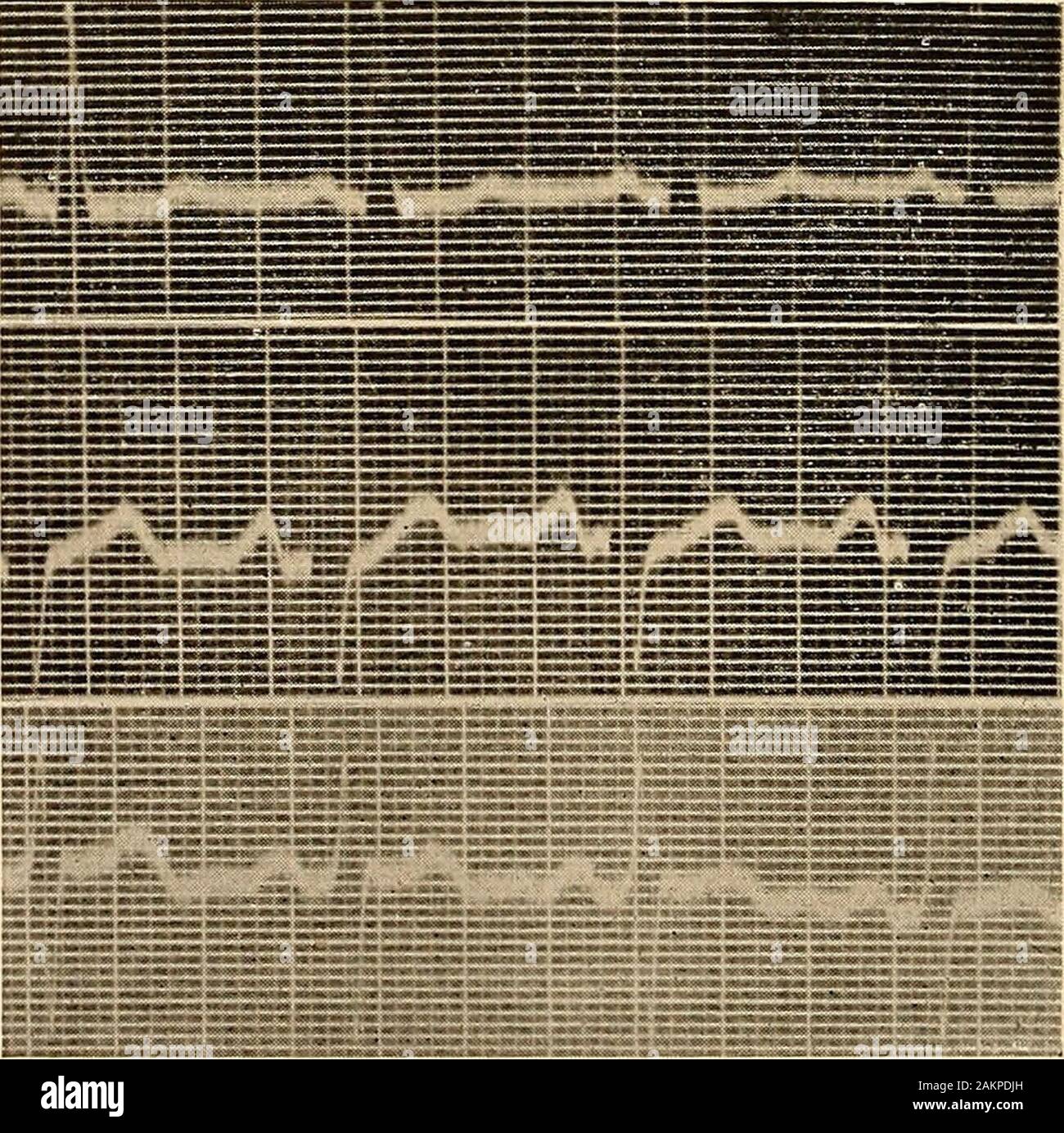 Clinical electrocardiography . Fig. 130.—Electrocardiogram of patient ...