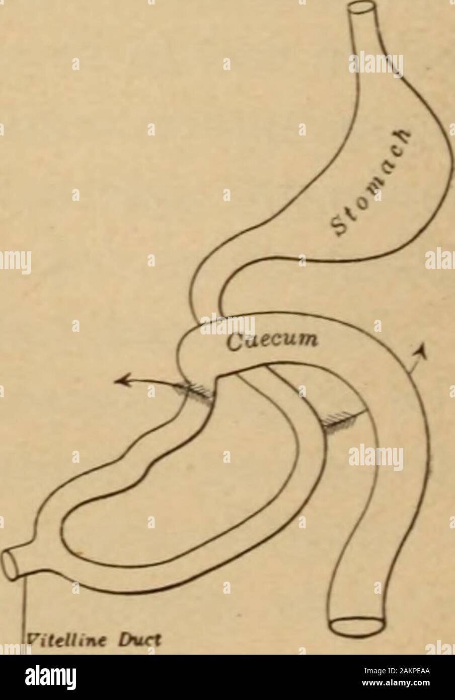 Left sided appendicitis hi-res stock photography and images - Alamy