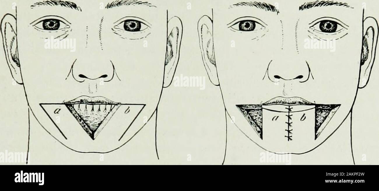 Surgeon Making Incision High Resolution Stock Photography and Images ...