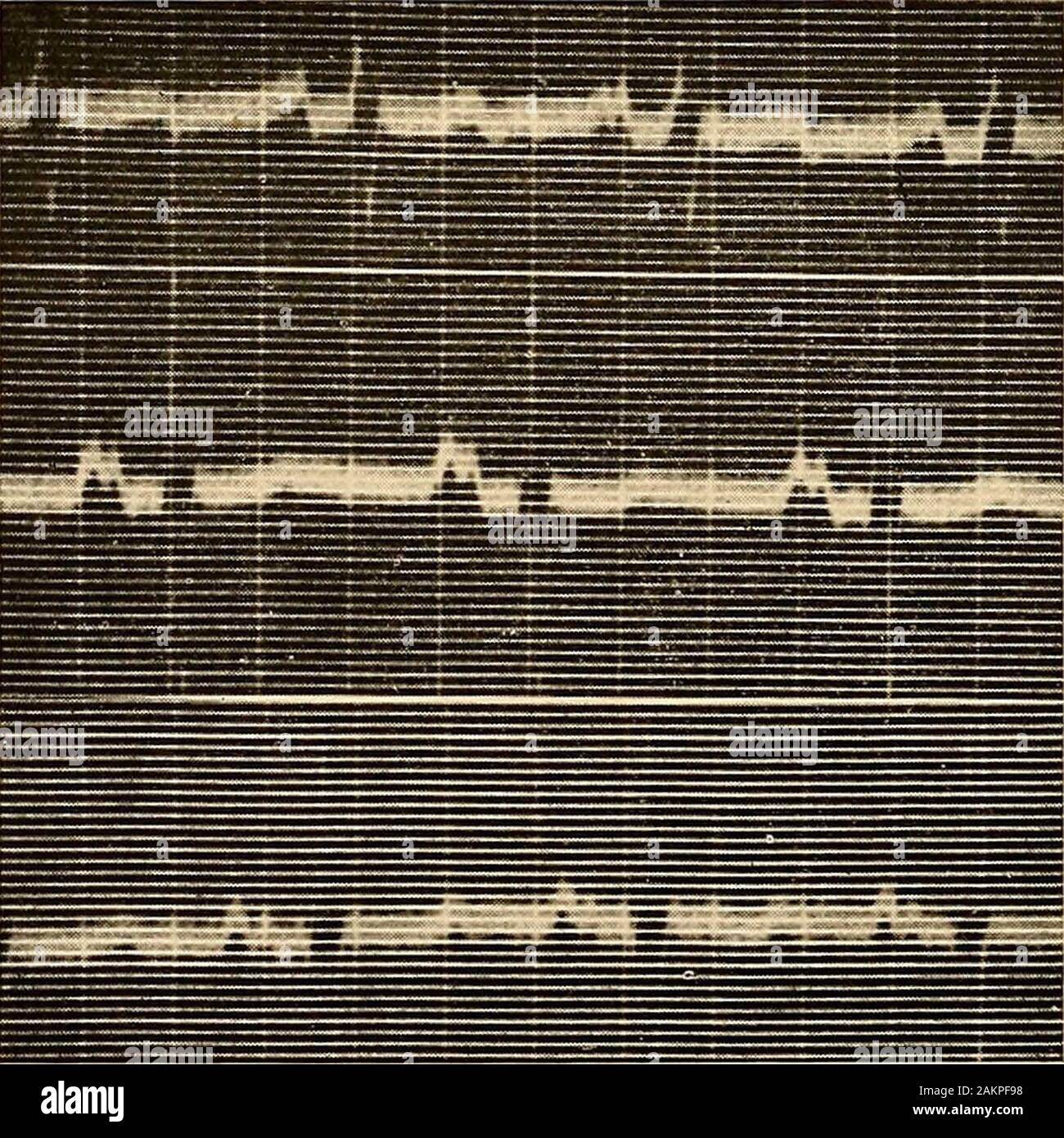 Clinical electrocardiography . Fig. 126.—Electrocardiogram of patient ...