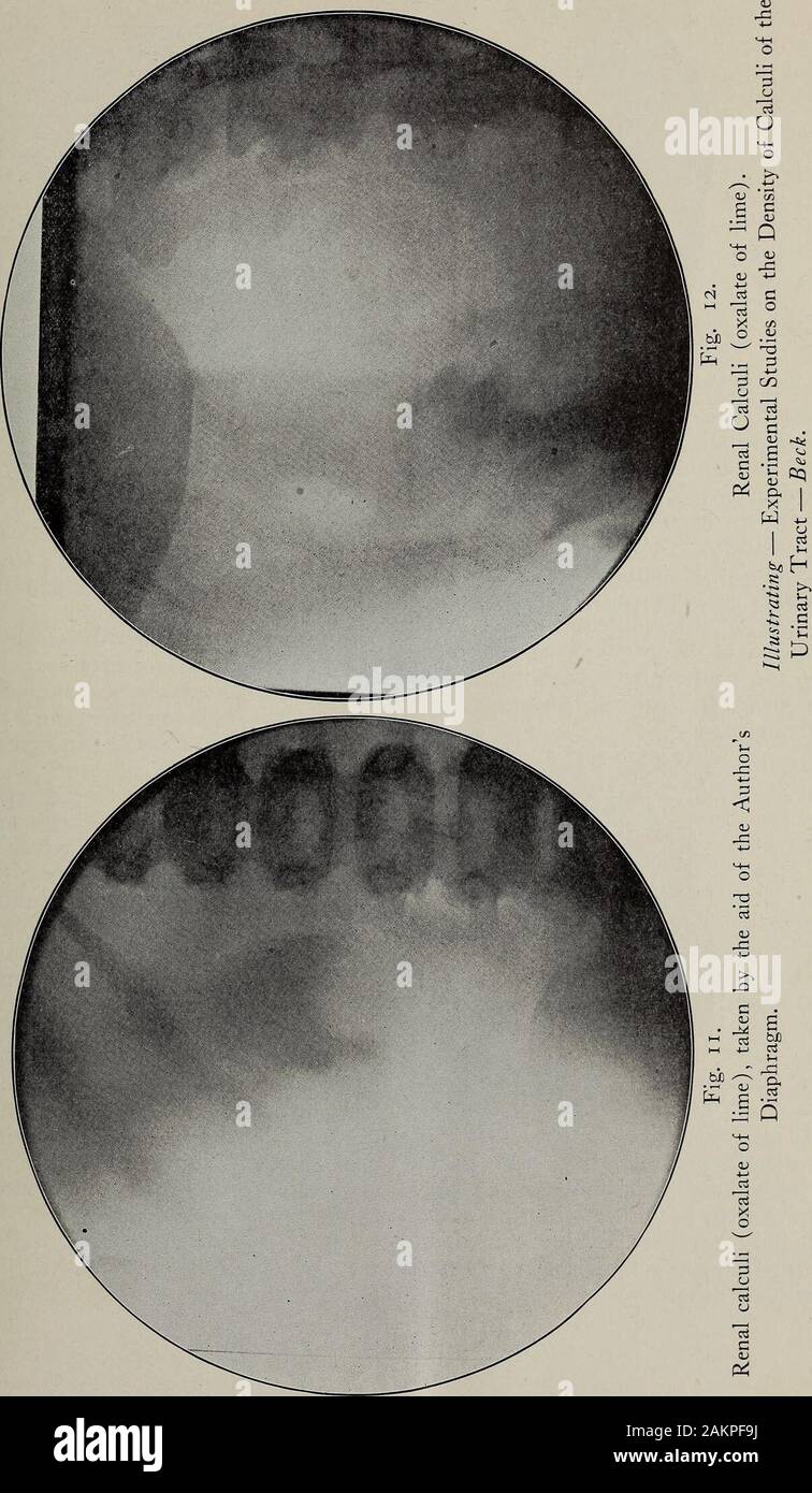 The archives of physiological therapy . Fig. 10. (a) Ureteral Calculus ...