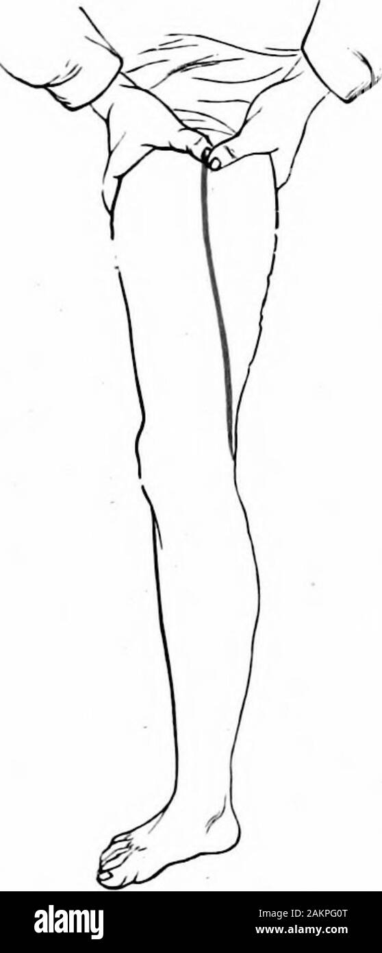 Bleeding wound on a leg Cut Out Stock Images & Pictures - Alamy