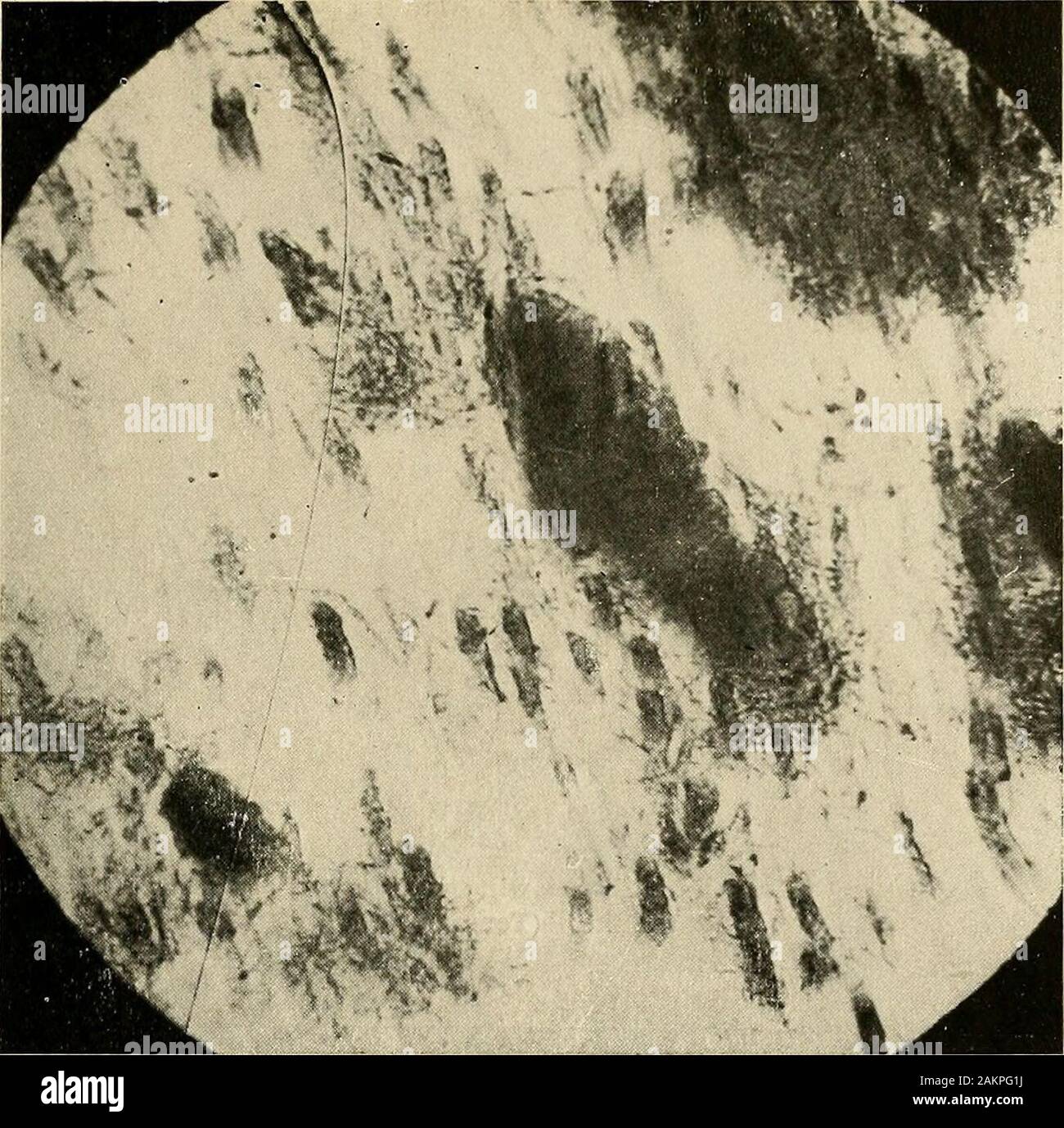 Principles and practice of operative dentistry . Fig. 285.—Infected ...