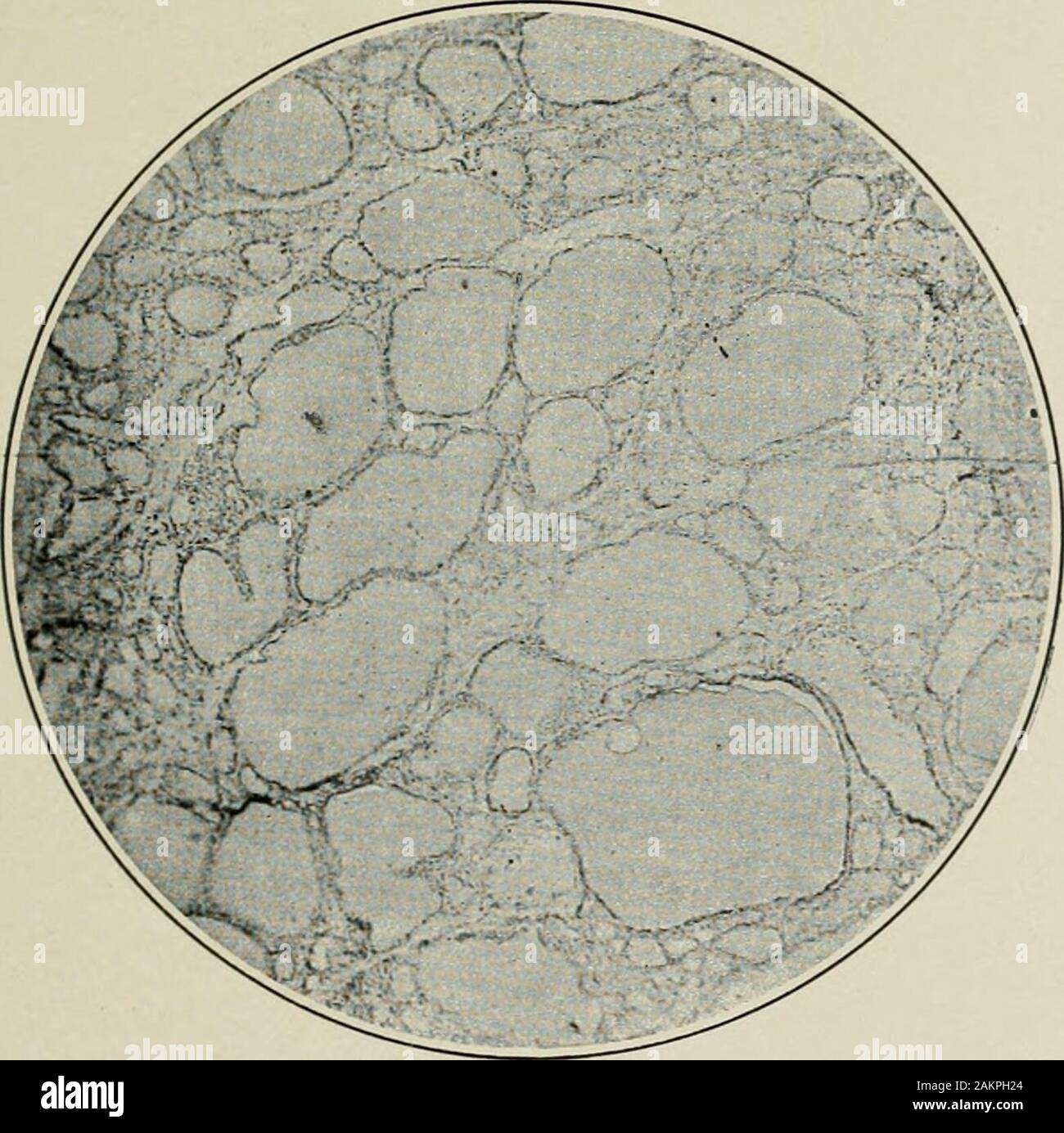Colloid cysts hi-res stock photography and images - Alamy