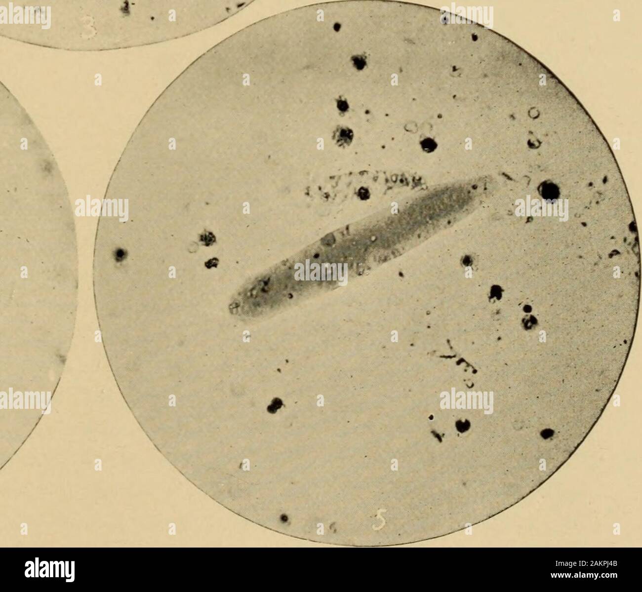 An American text-book of the diseases of children .. . TUBE-CASTS AND ...