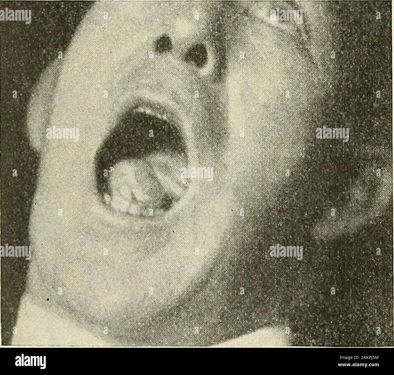 Thyrohyoid hi-res stock photography and images - Alamy