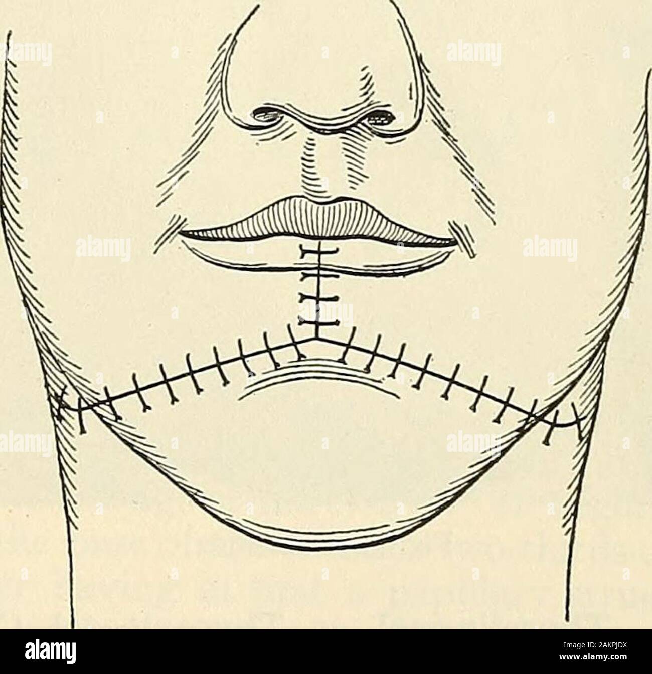 Modern surgery, general and operative . Fig. 585.—Grants method for ...